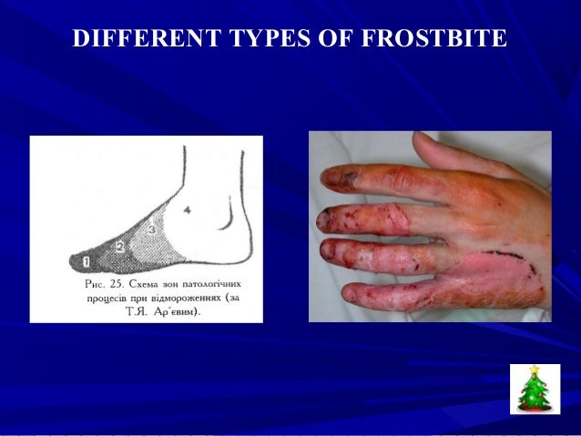 Thermal Trauma. Burns, Electrical Trauma, Frost Bite