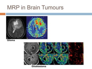 Magnetic Resonance Perfusion | PPTX