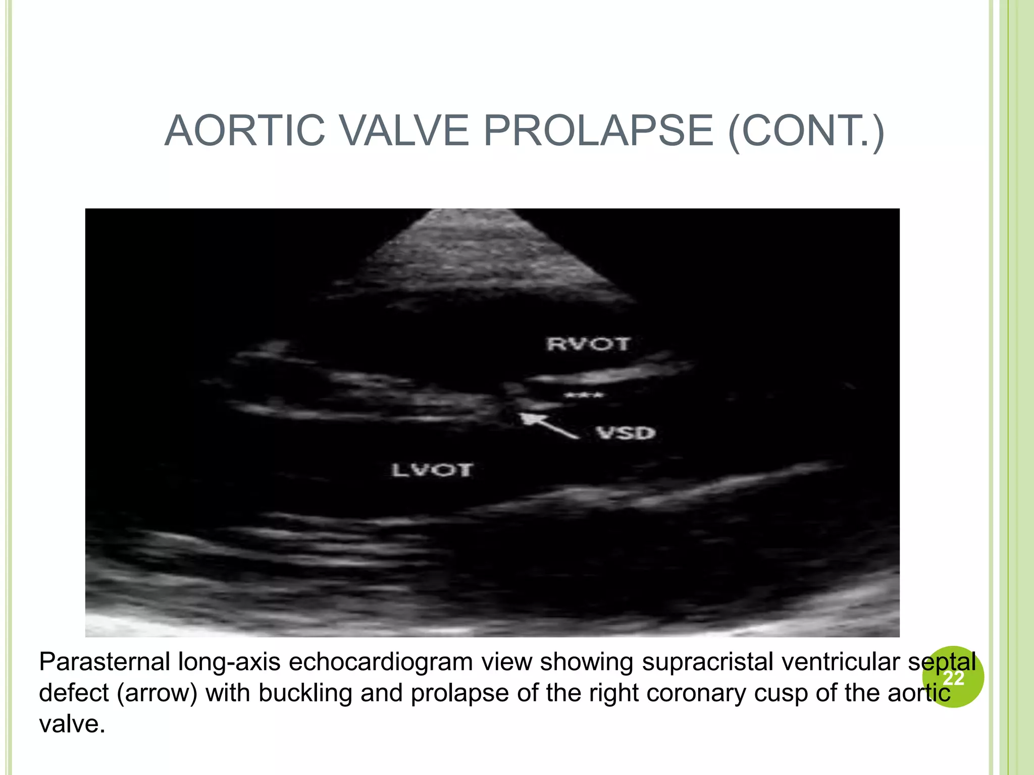 NATURAL HISTORY OF ASD, VSD, PDA | PPTX
