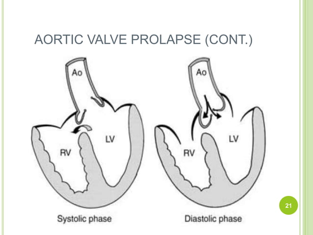 NATURAL HISTORY OF ASD, VSD, PDA | PPTX | Heart and Cardiovascular ...