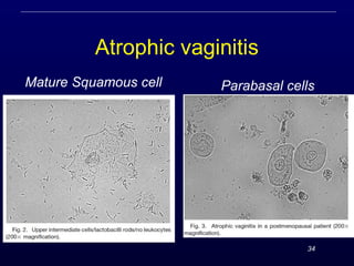 Parabasal Cells Wet Prep