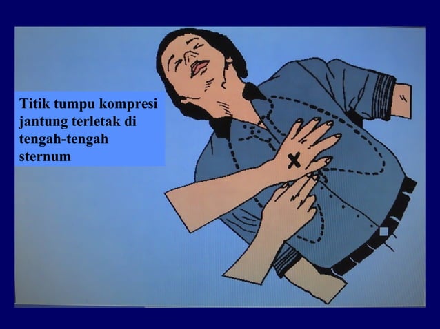 Cardiopulmonary Resuscitation (CPR) atau Resusitasi Jantung Paru-paru