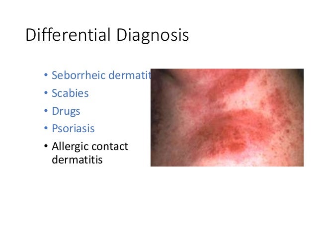 атопийн дерматит