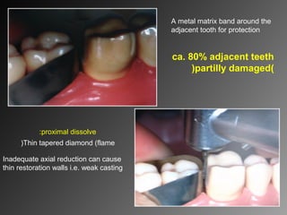 3.principles of tooth preparation (general) | PPT