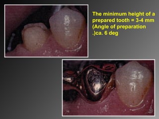 3.principles of tooth preparation (general) | PPT