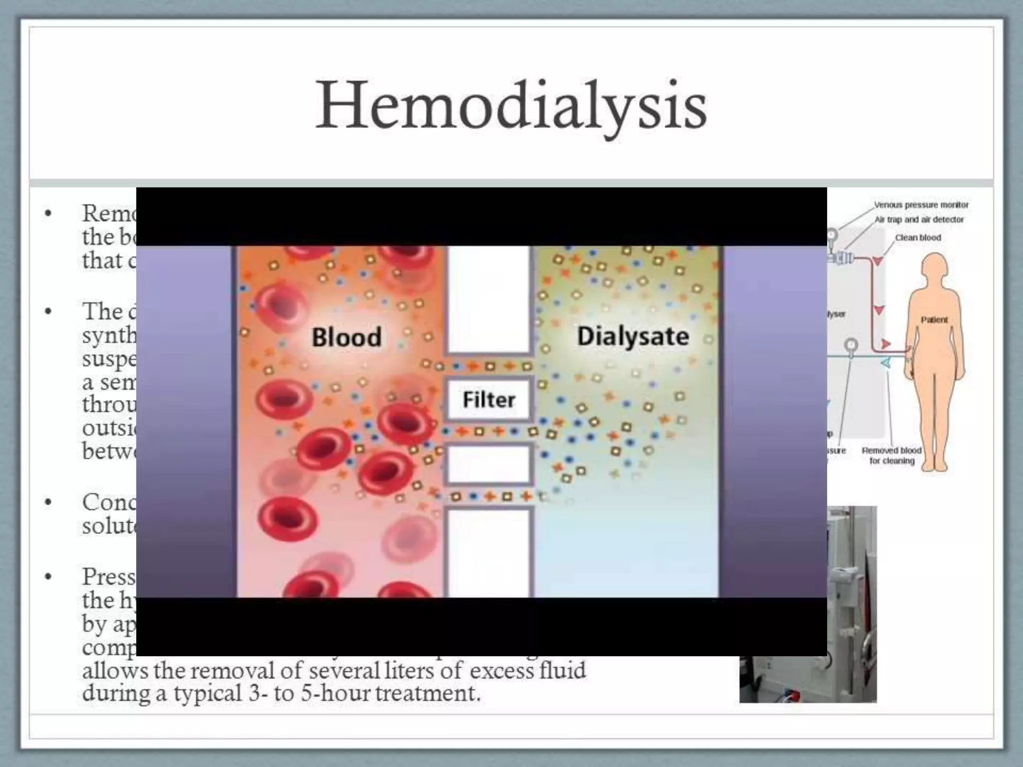 Hemodialysis complications | PPTX