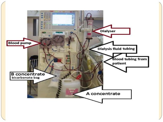Hemodialysis complications | PPTX