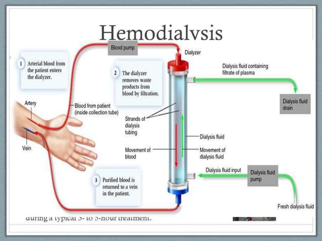 Hemodialysis complications | PPT