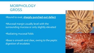 Pathology of Peptic Ulcer Disease | PPTX