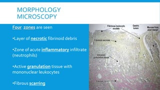 Pathology of Peptic Ulcer Disease | PPTX