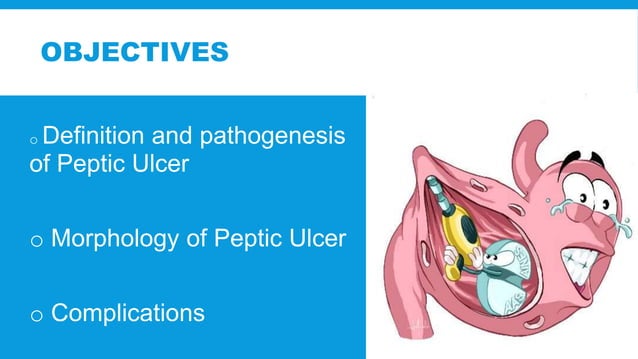 Pathology of Peptic Ulcer Disease | PPTX | Digestive Disorders ...