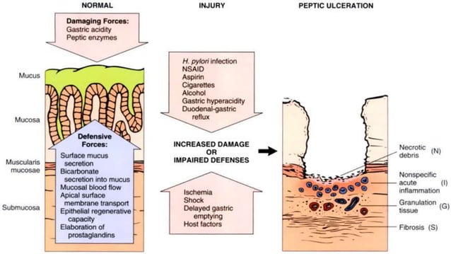 Pathology of Peptic Ulcer Disease | PPTX | Digestive Disorders ...