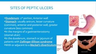 Pathology of Peptic Ulcer Disease | PPT