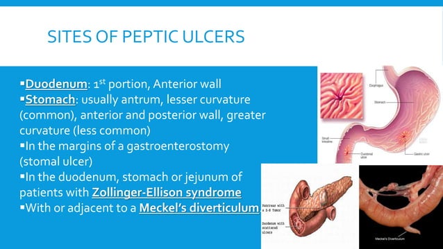 Pathology of Peptic Ulcer Disease | PPT