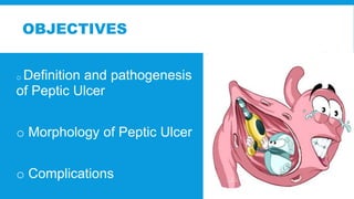 Pathology of Peptic Ulcer Disease | PPT