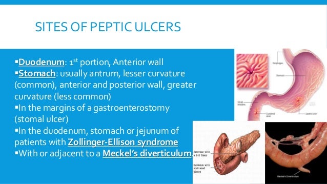 Pathology of Peptic Ulcer Disease