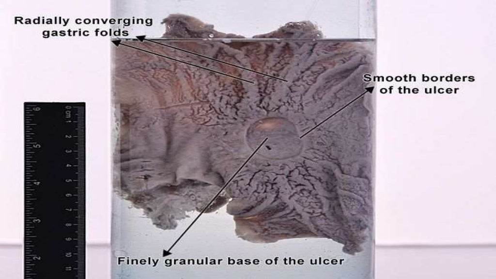 Pathology of Peptic Ulcer Disease