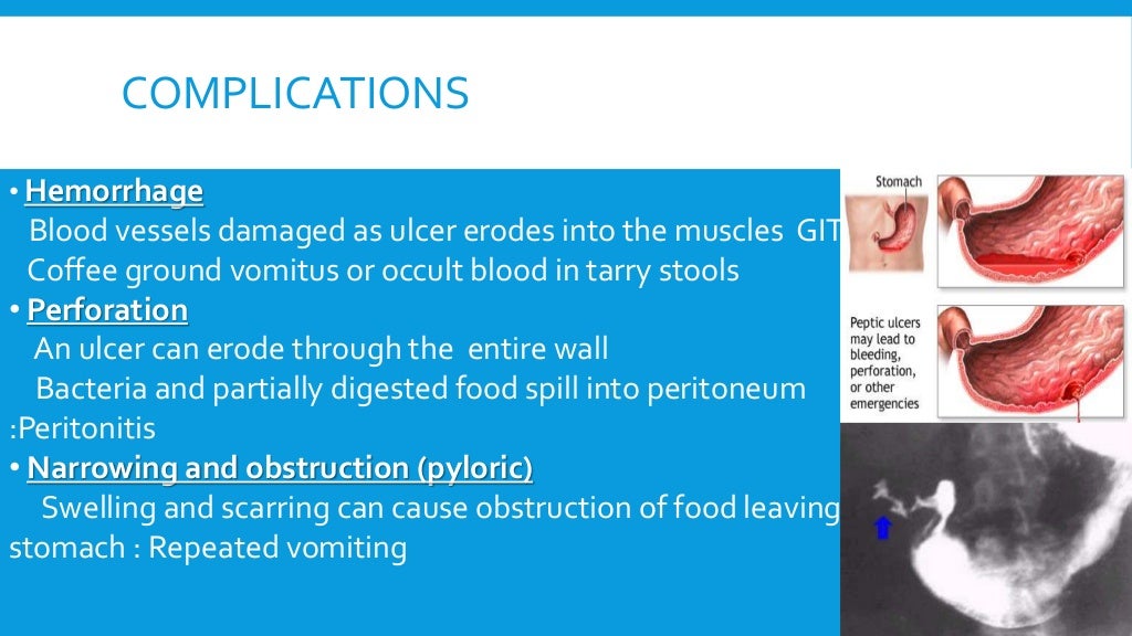 Pathology of Peptic Ulcer Disease