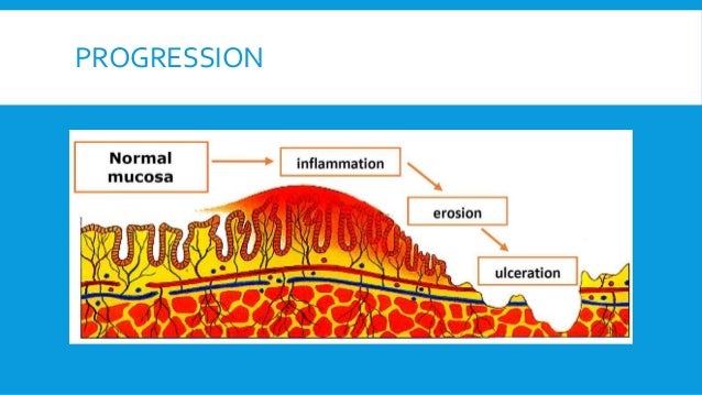 Pathology of Peptic Ulcer Disease