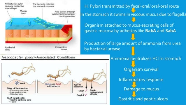 Pathology of Peptic Ulcer Disease