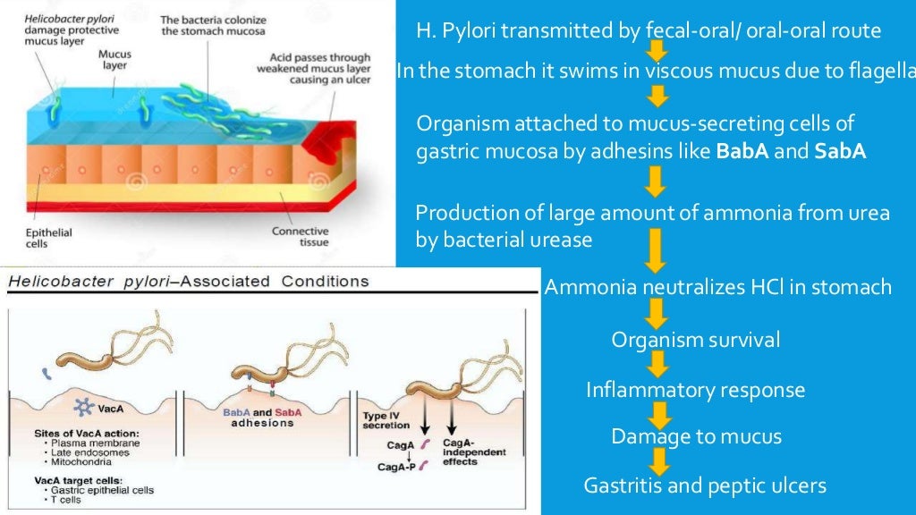 Pathology of Peptic Ulcer Disease