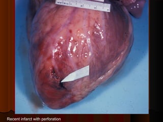 3.Ischemic heart disease( coronary artery disease) | PPT