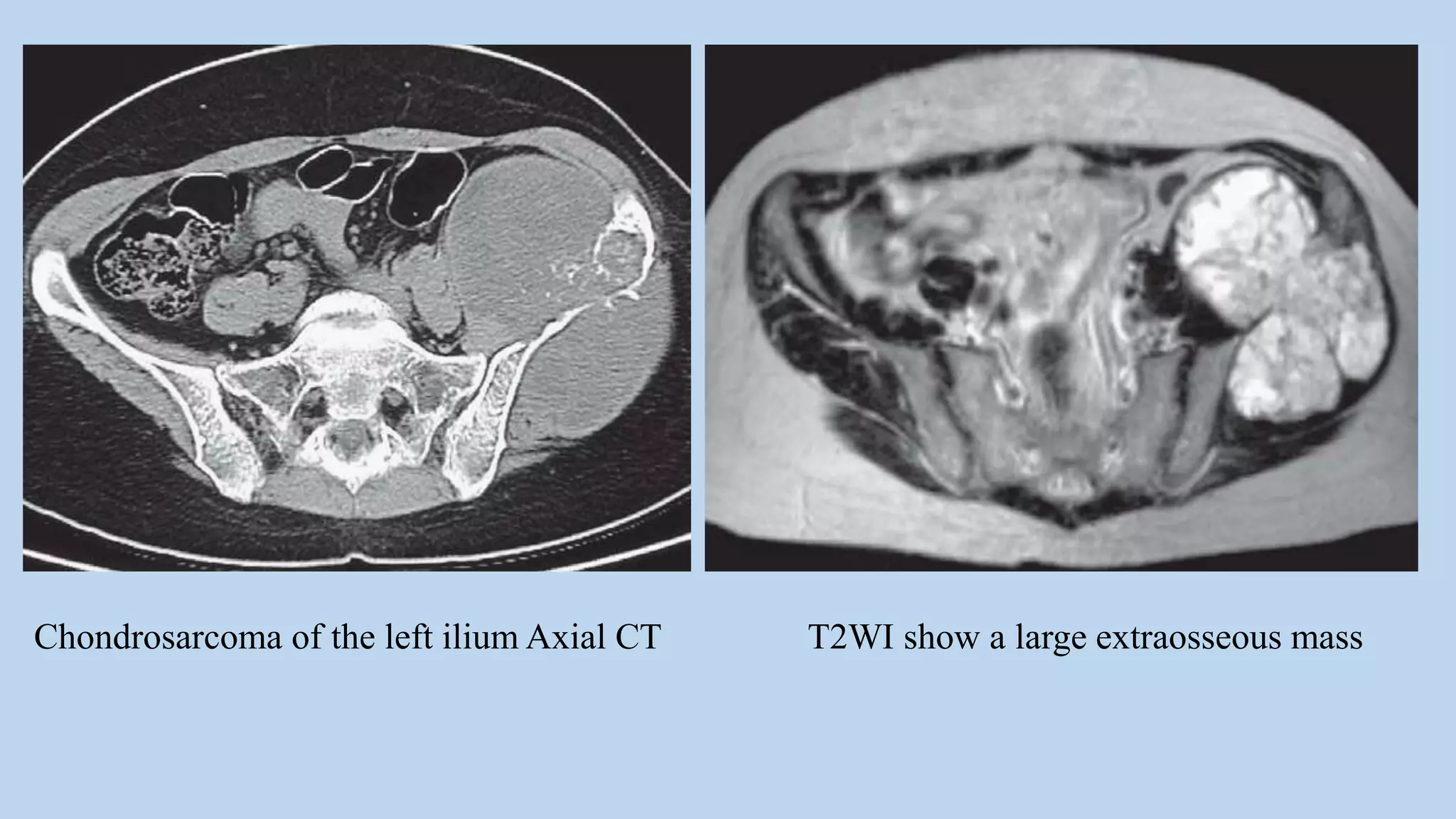 Malignant bone tumours | PPTX | Bone and Joint Conditions | Diseases ...