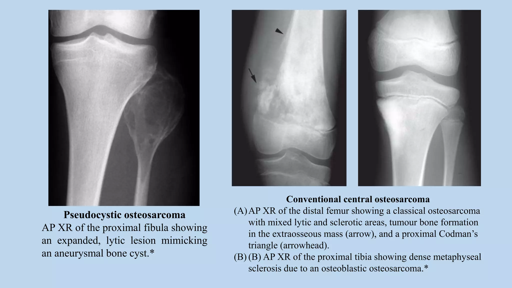 Malignant bone tumours | PPTX | Bone and Joint Conditions | Diseases ...