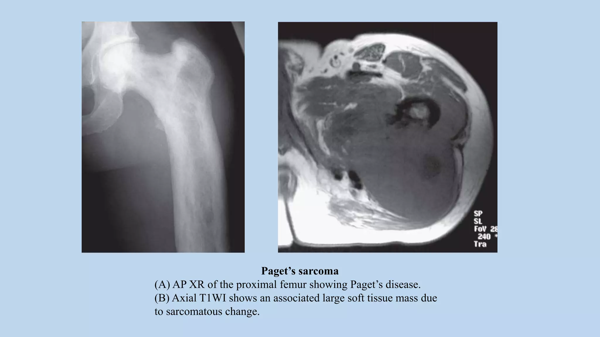 Malignant bone tumours | PPTX | Bone and Joint Conditions | Diseases ...