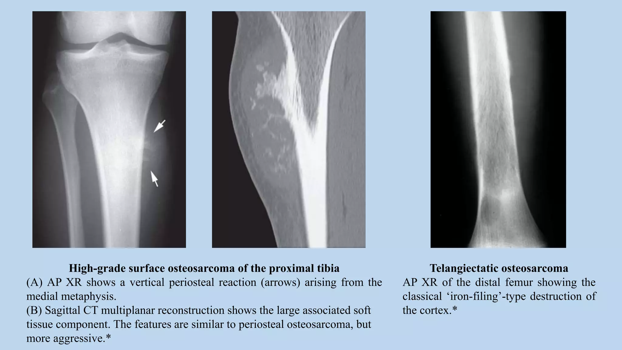 Malignant bone tumours | PPTX | Bone and Joint Conditions | Diseases ...