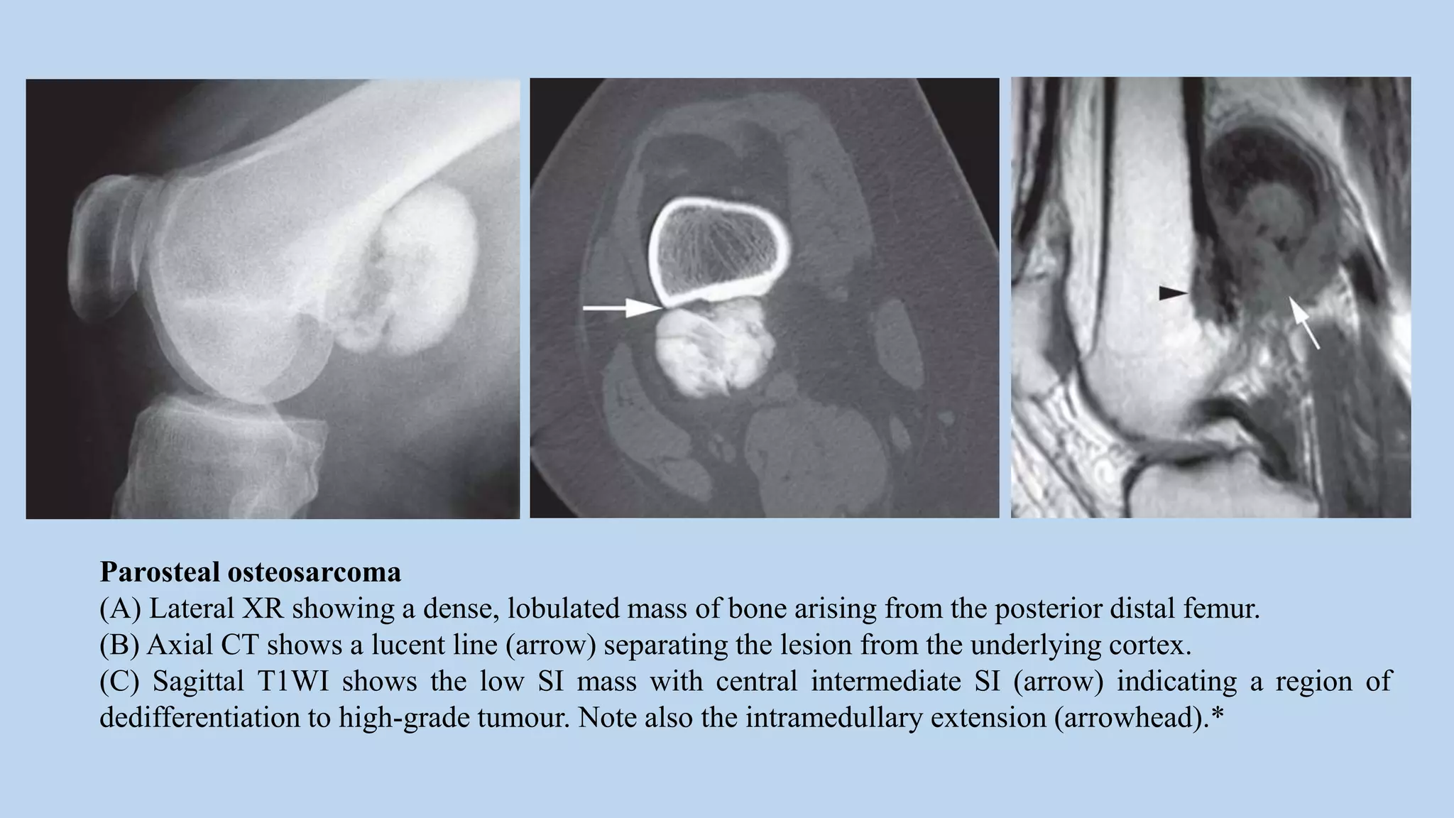 Malignant bone tumours | PPTX | Bone and Joint Conditions | Diseases ...