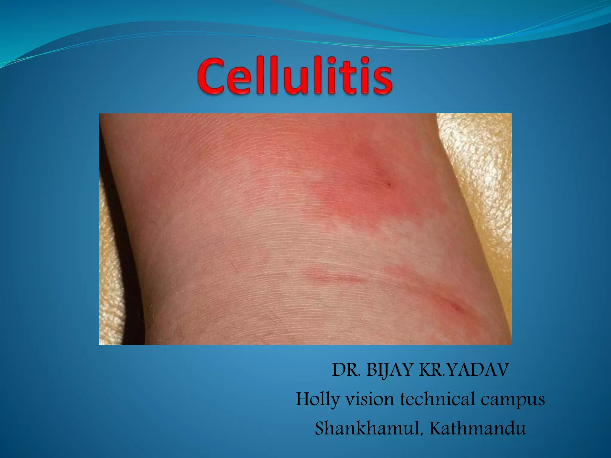 3. Cellulitis | PPTX