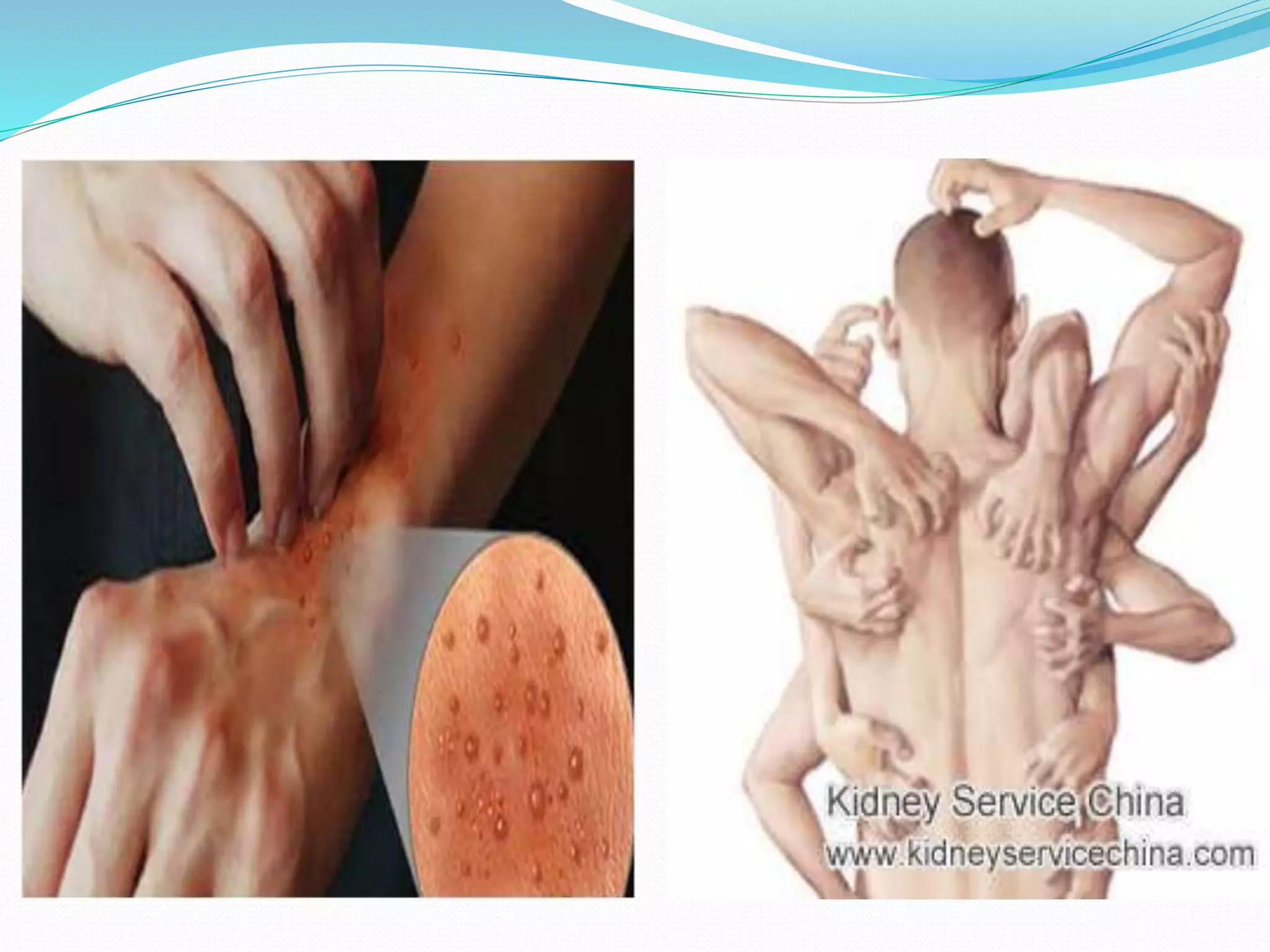 3. Cellulitis | PPTX