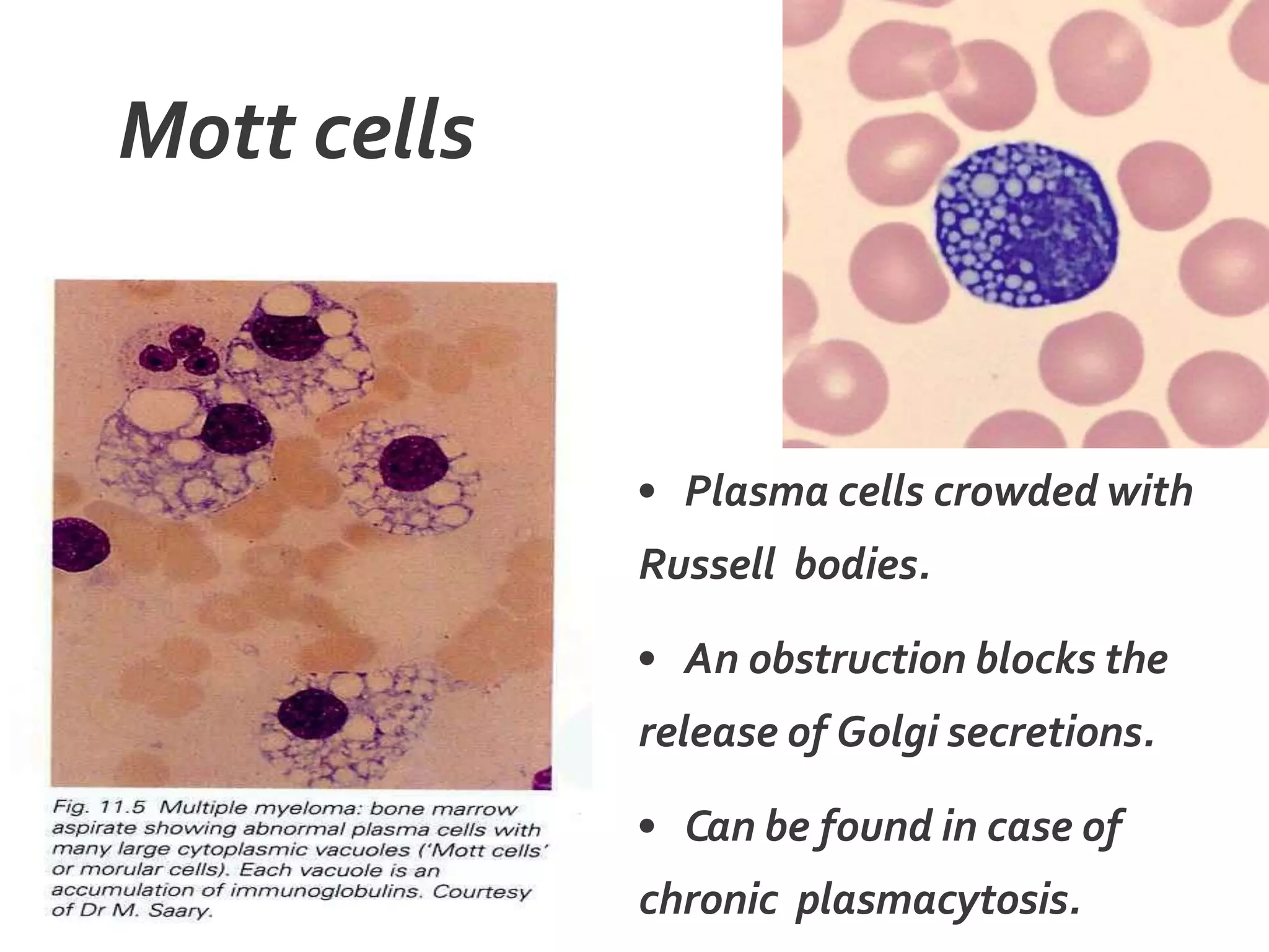 Plasma Cell Disorders | PPTX