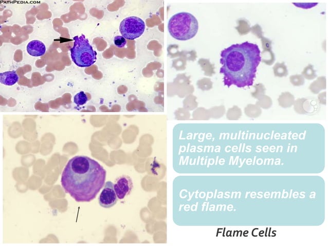 Plasma Cell Disorders | PPTX