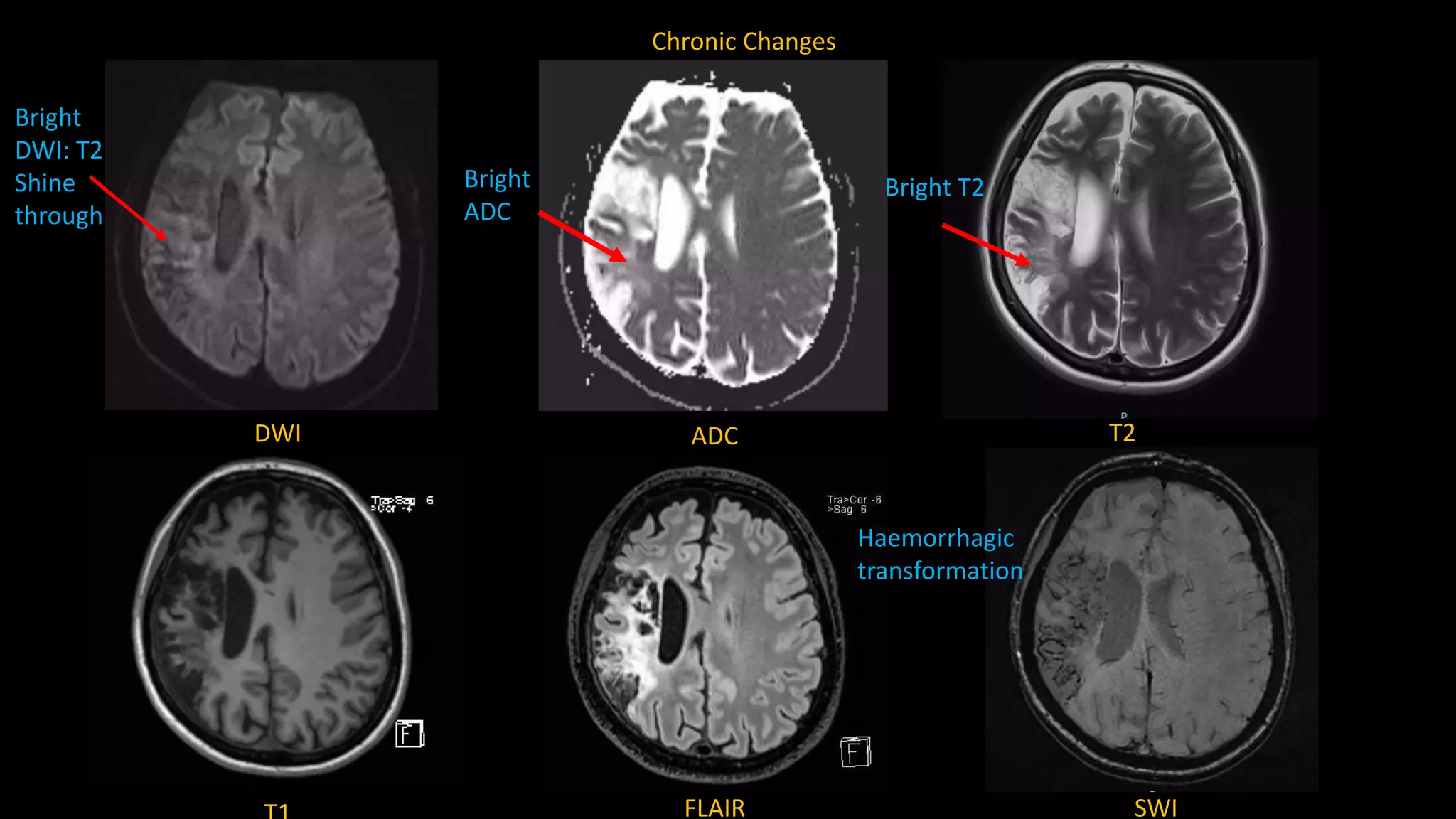 3. mri in acute stroke 2017 vietnam v2 | PPTX