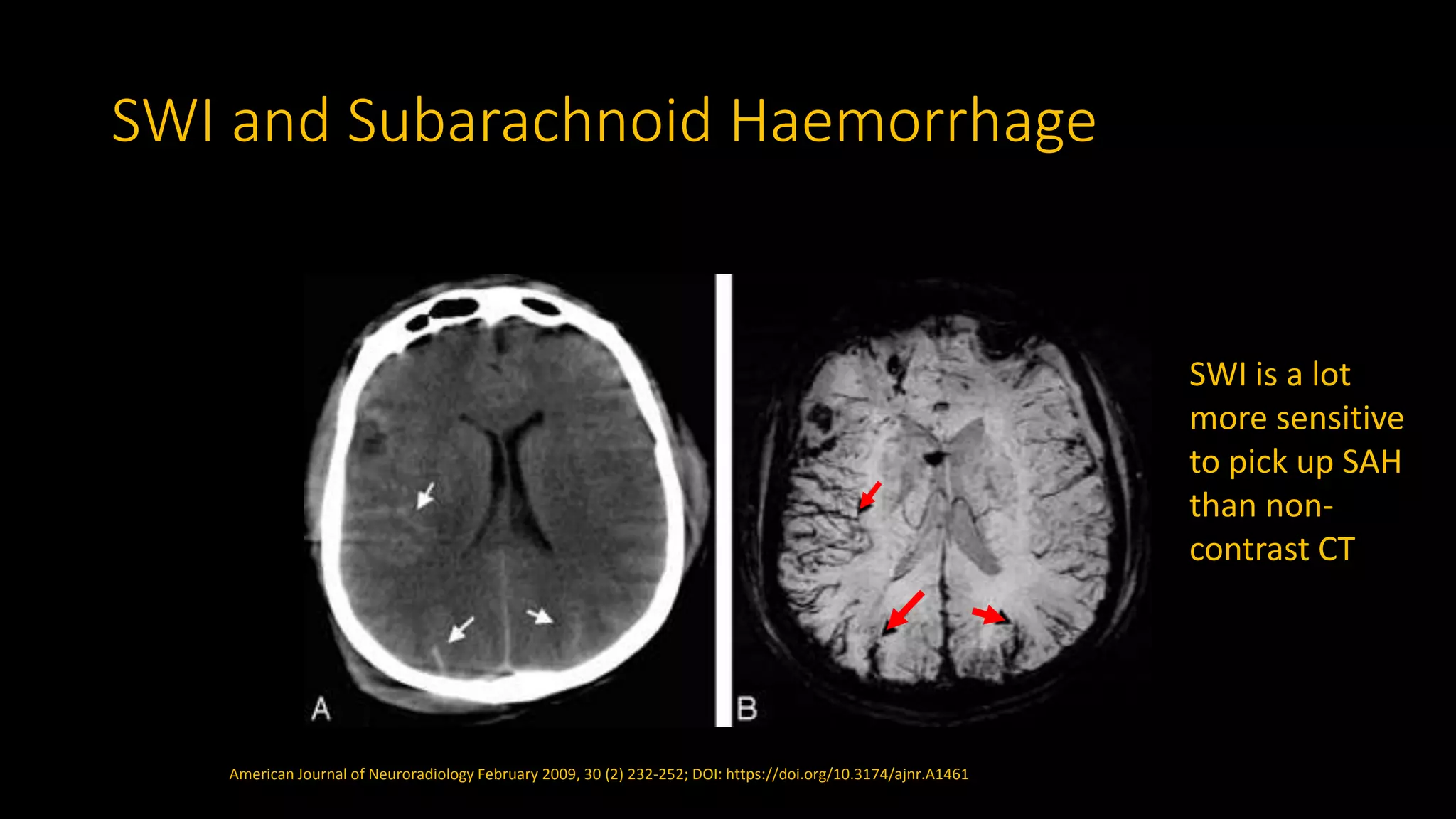 3. mri in acute stroke 2017 vietnam v2 | PPTX