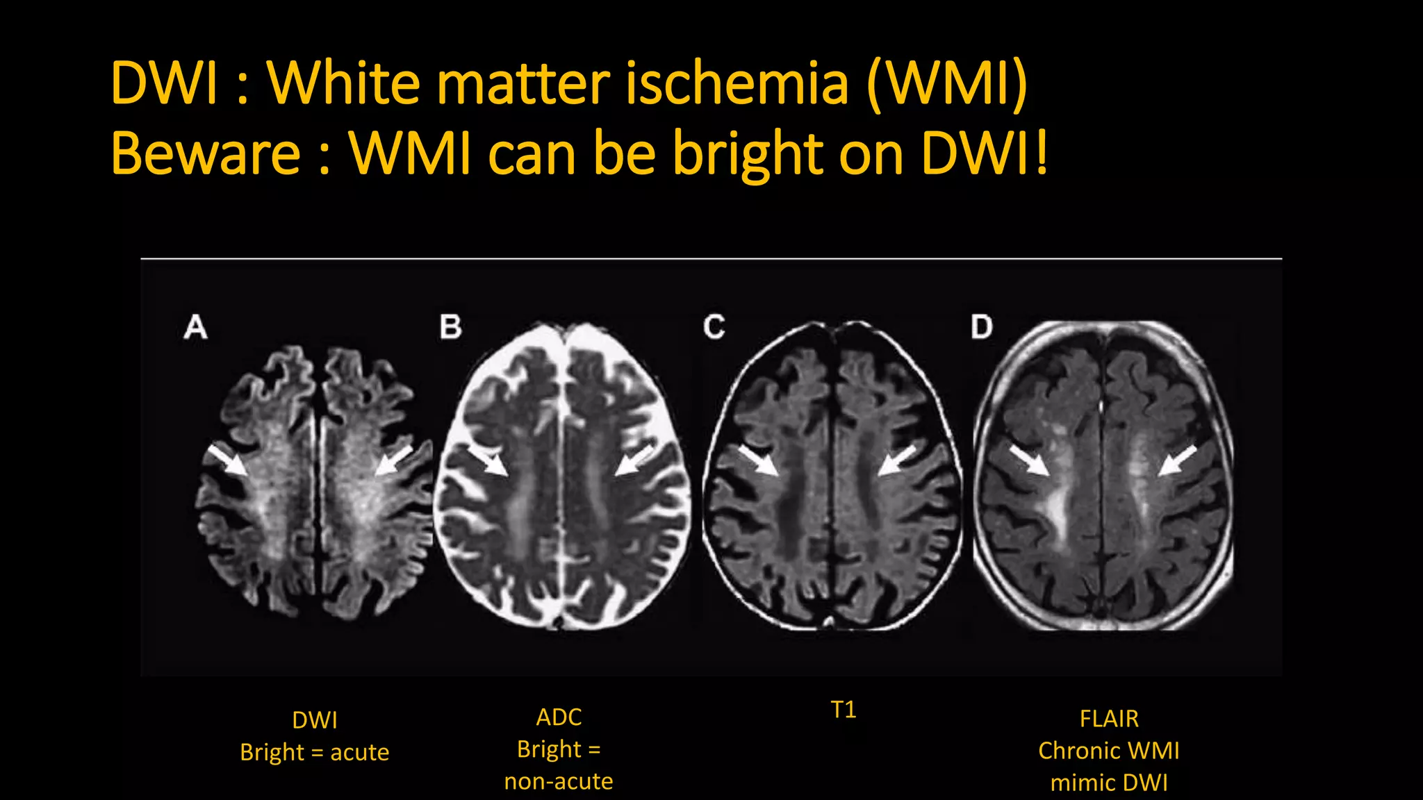 3. mri in acute stroke 2017 vietnam v2 | PPTX
