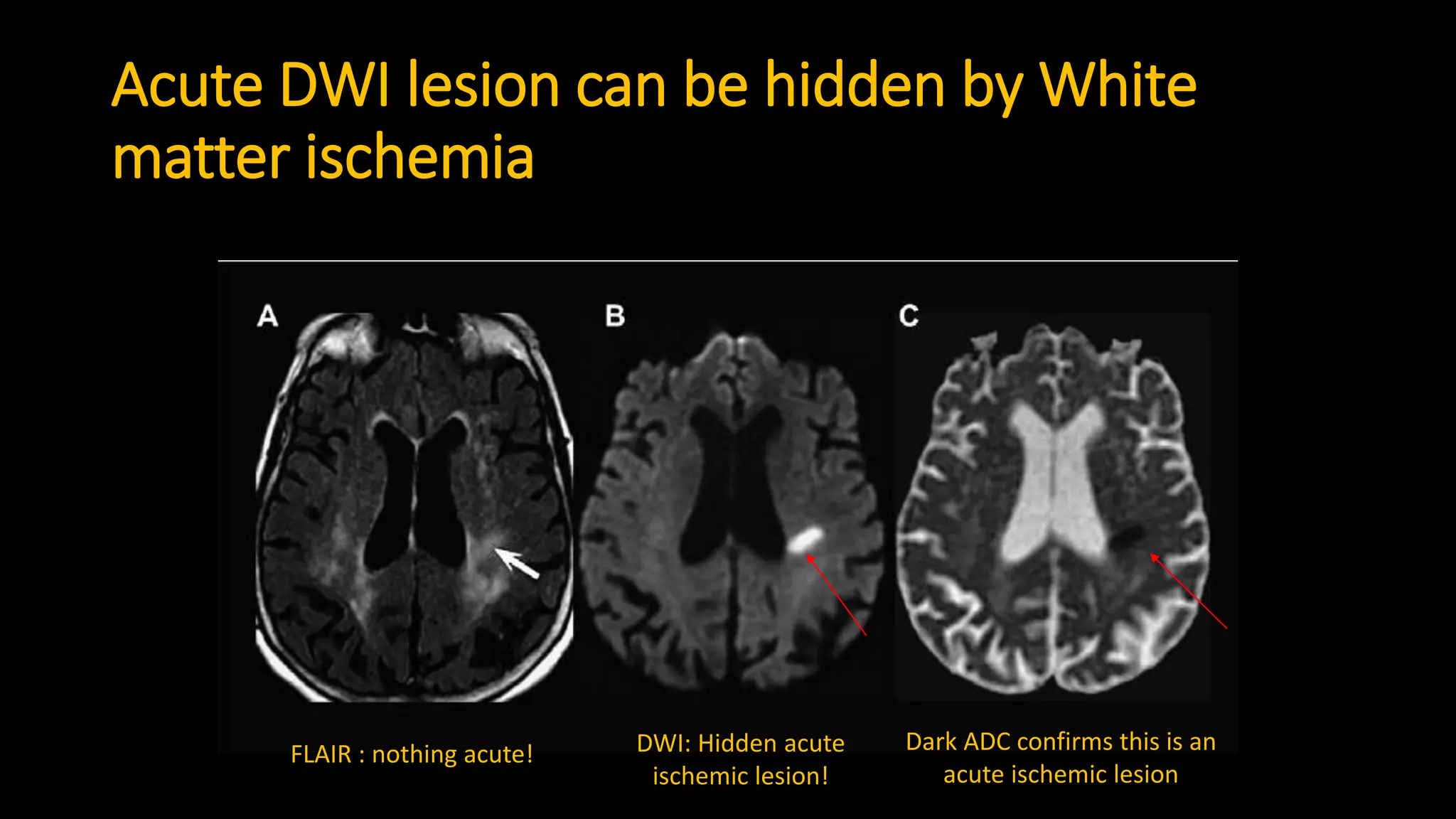 3. mri in acute stroke 2017 vietnam v2 | PPTX