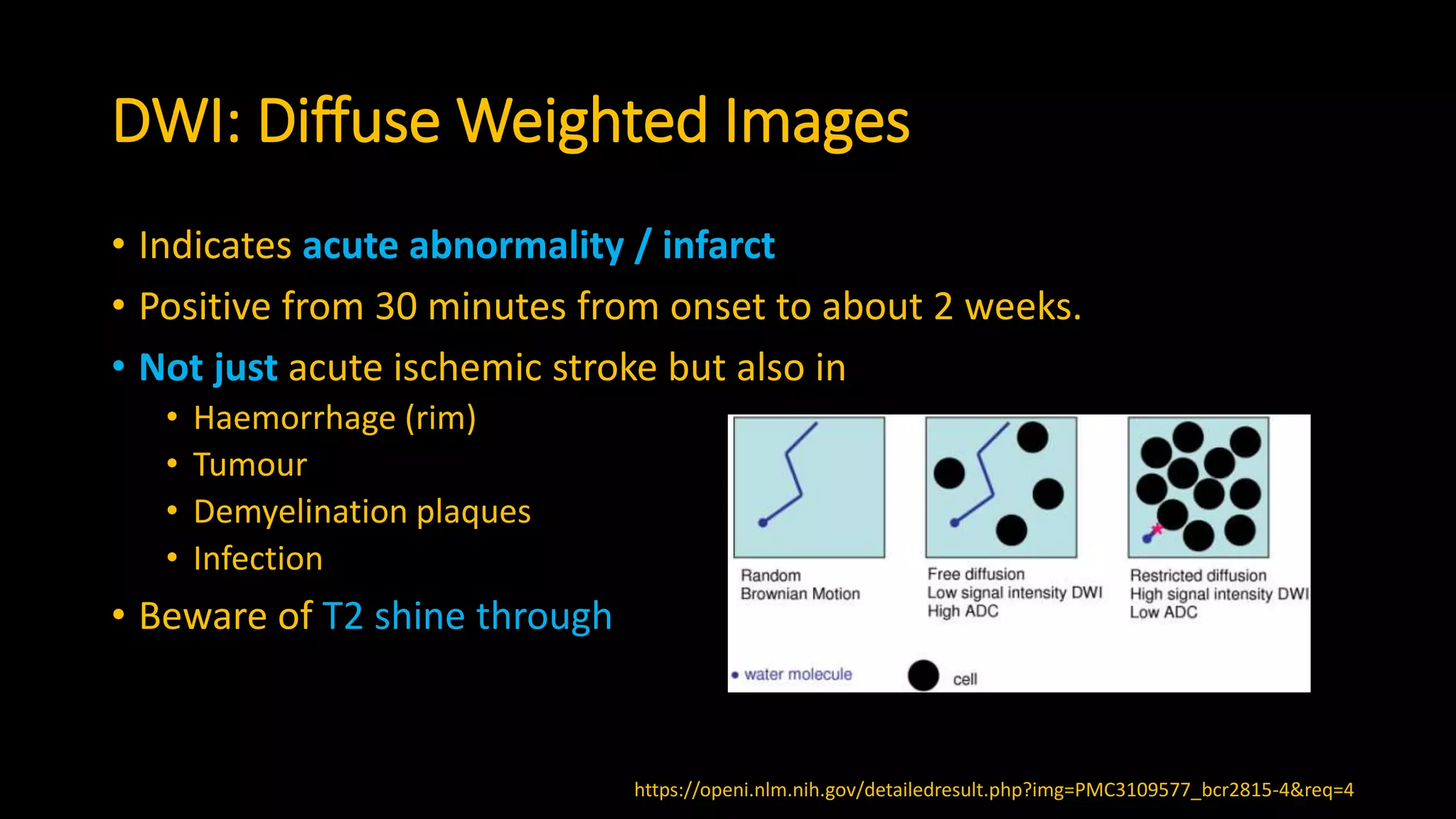 3. mri in acute stroke 2017 vietnam v2 | PPTX