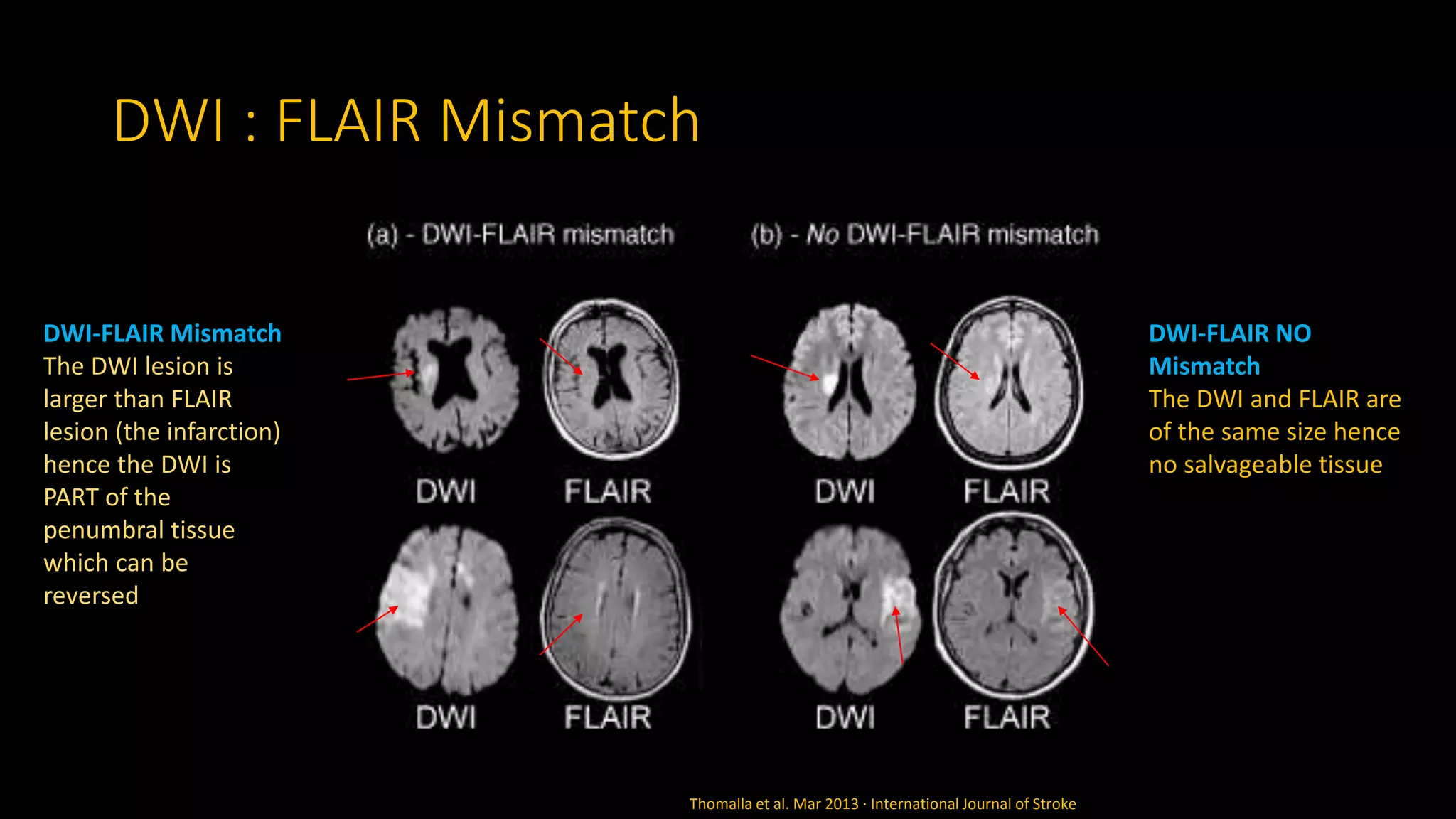 3. mri in acute stroke 2017 vietnam v2 | PPTX