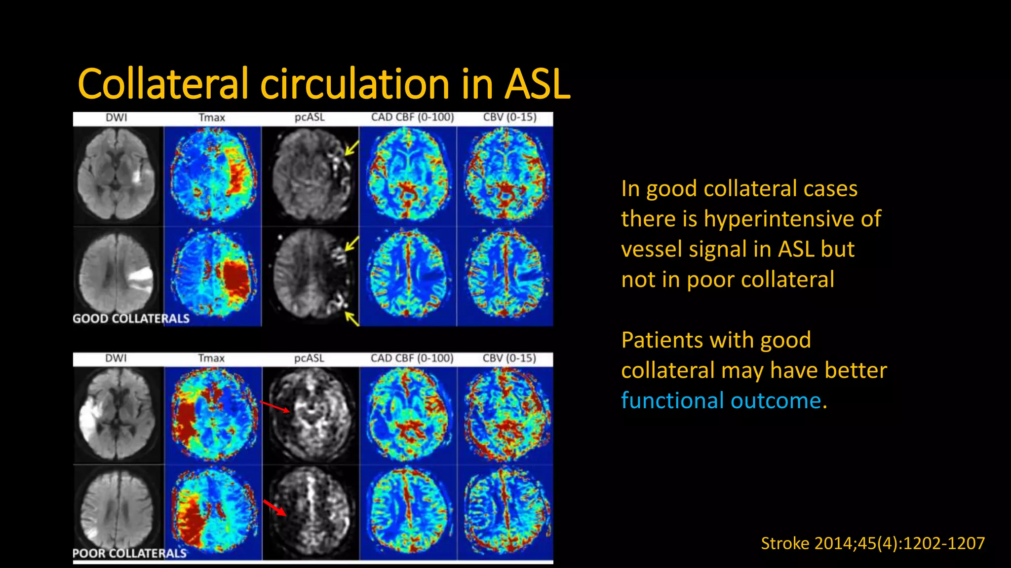 3. mri in acute stroke 2017 vietnam v2 | PPTX