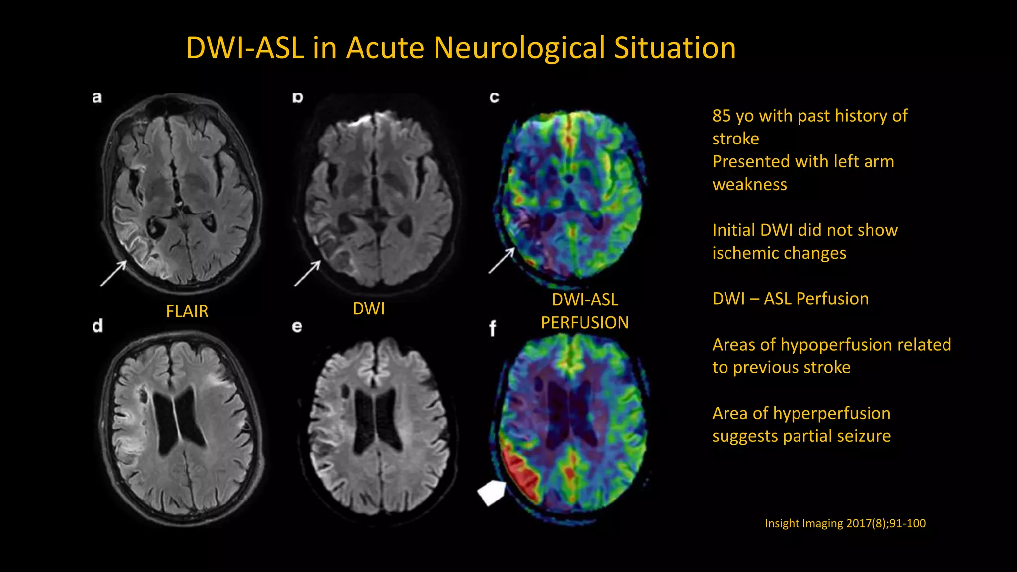3. mri in acute stroke 2017 vietnam v2 | PPTX