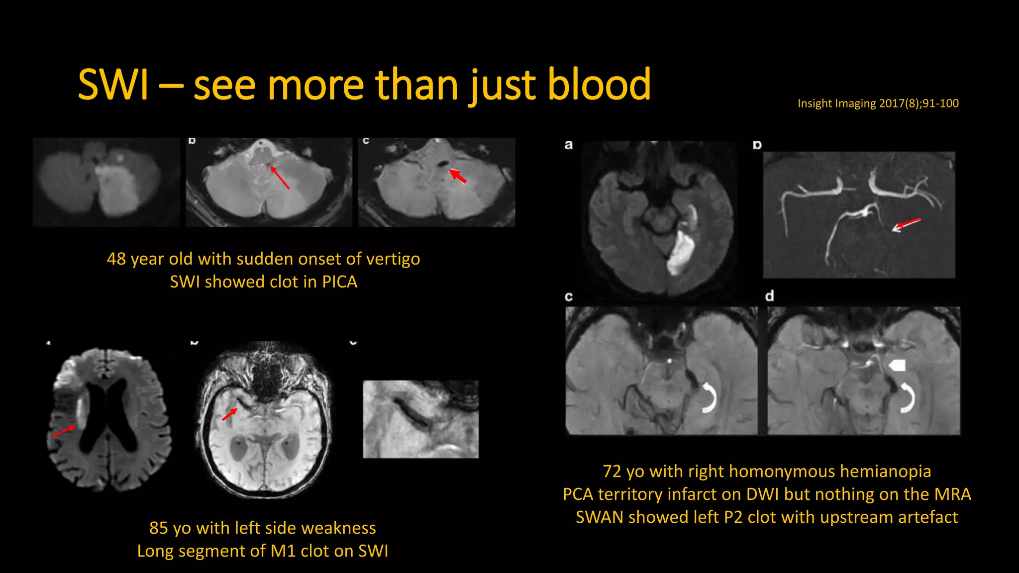 3. mri in acute stroke 2017 vietnam v2 | PPTX