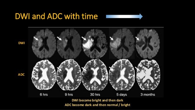 3. mri in acute stroke 2017 vietnam v2