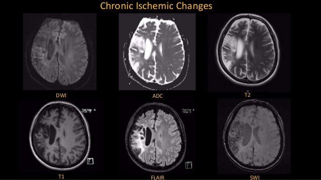 3. mri in acute stroke 2017 vietnam v2