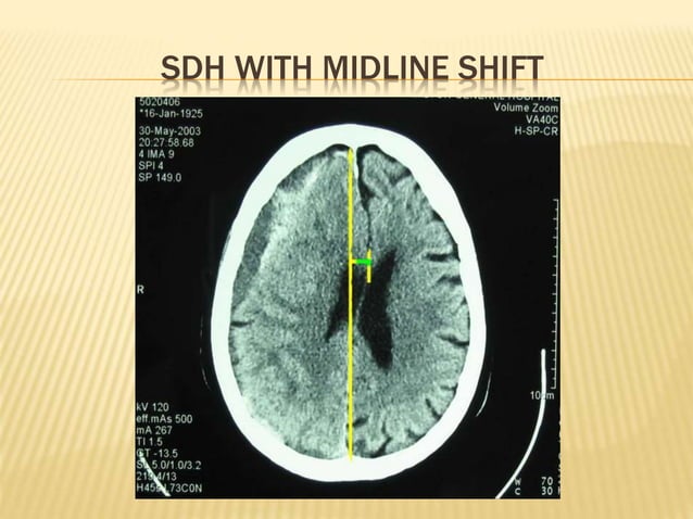 General arrangement & development of brain | PPTX