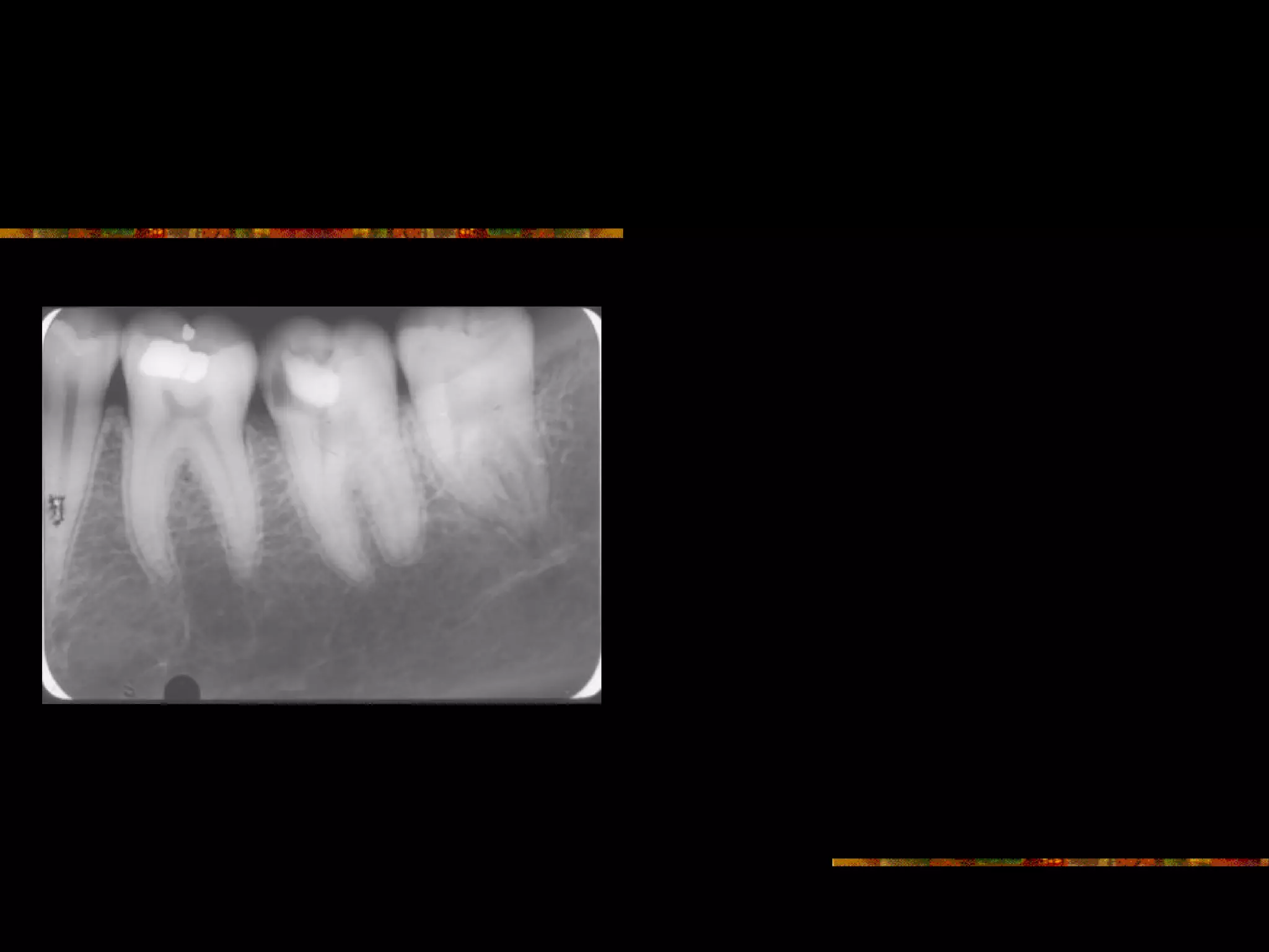 Intra Oral radiographic anatomical landmarks | PPT