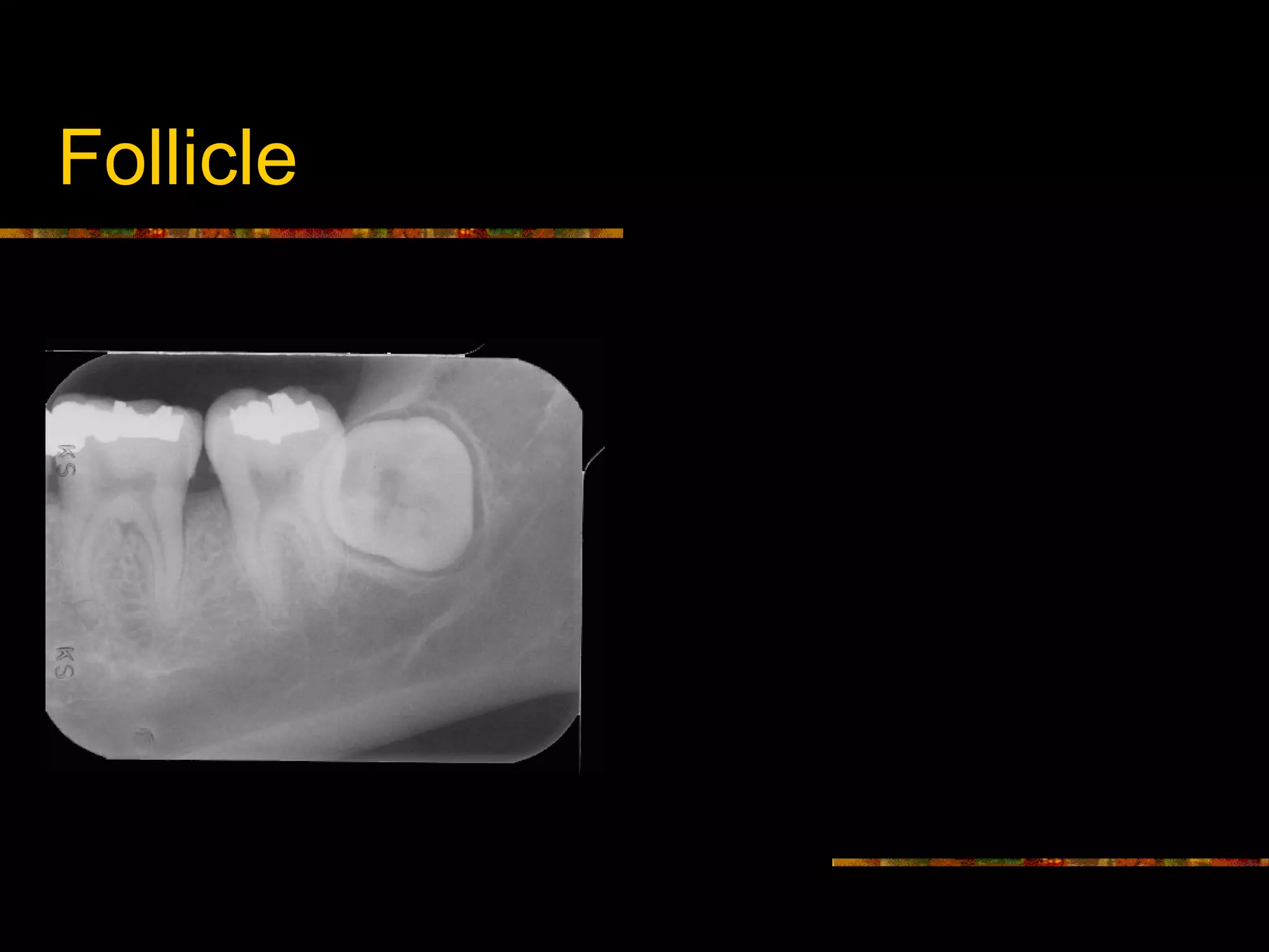 Intra Oral radiographic anatomical landmarks | PPT