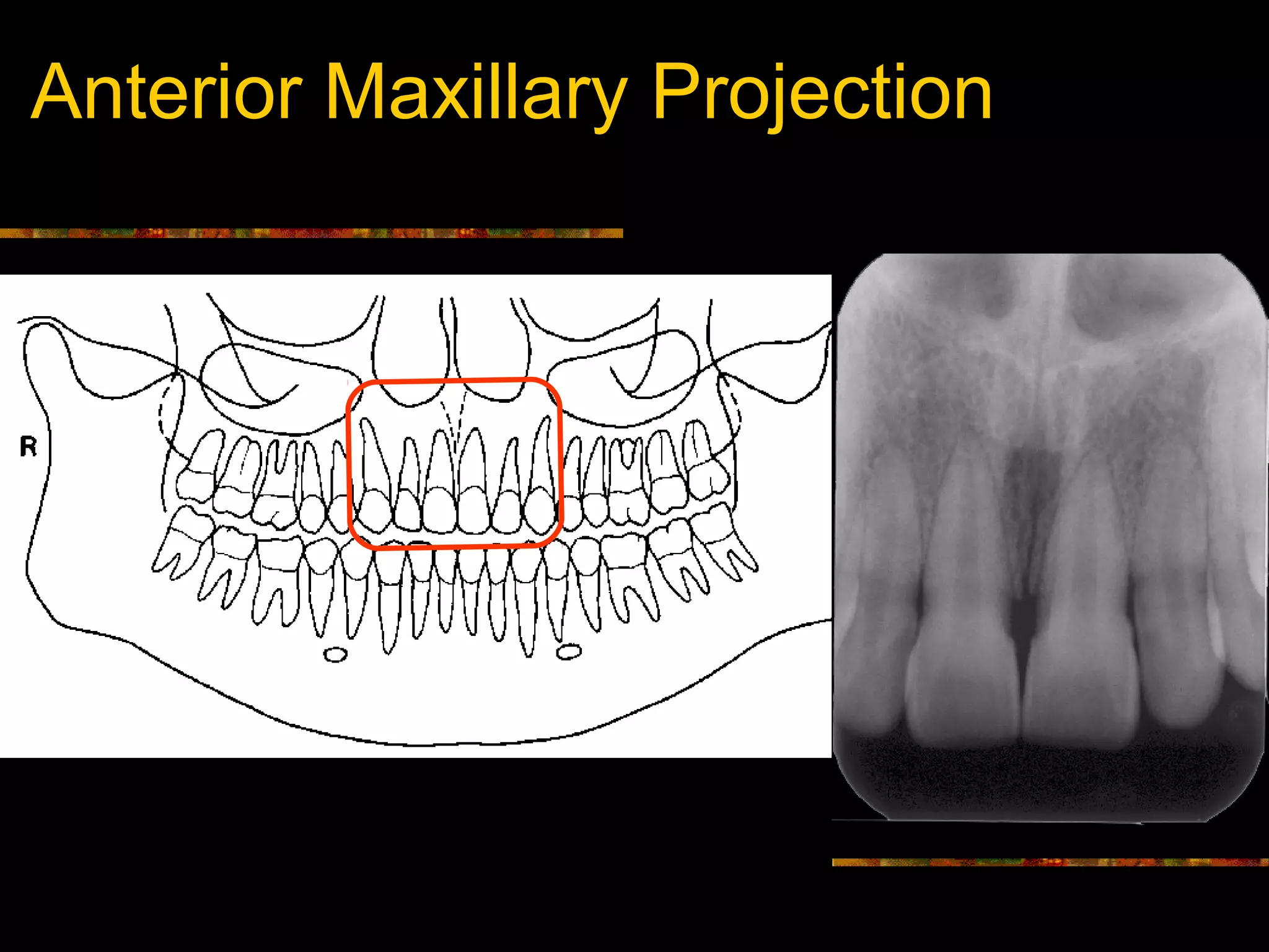 Intra Oral radiographic anatomical landmarks | PPT